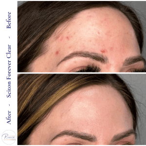 Sciton Forever Clear BBL - Renew Medical Aesthetics